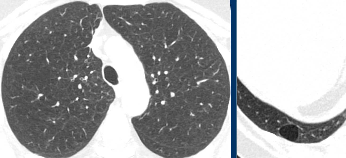 The Radiology Assistant : Cystic Lung Disease - Differential diagnosis