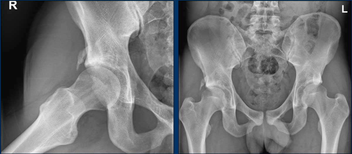 The Radiology Assistant : Femoroacetabular impingement syndrome