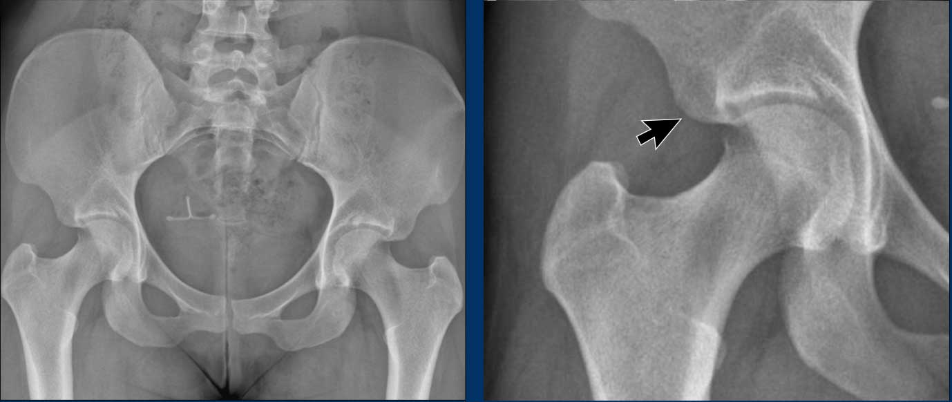 The Radiology Assistant : Femoroacetabular impingement syndrome