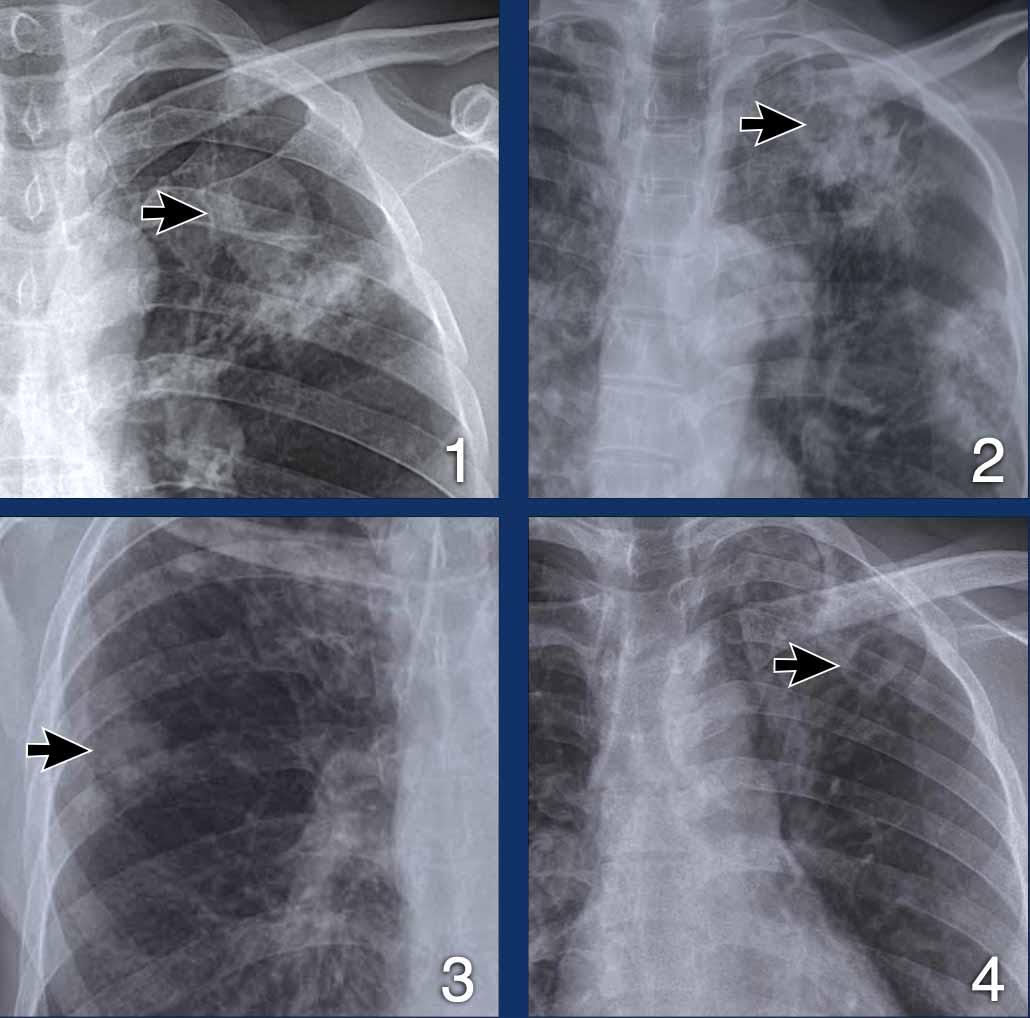 Chest Xray Tb Chest Xray Tb