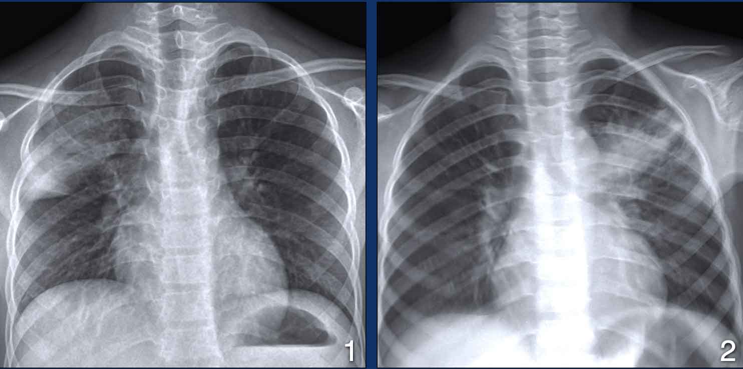The Radiology Assistant : Imaging findings in TB