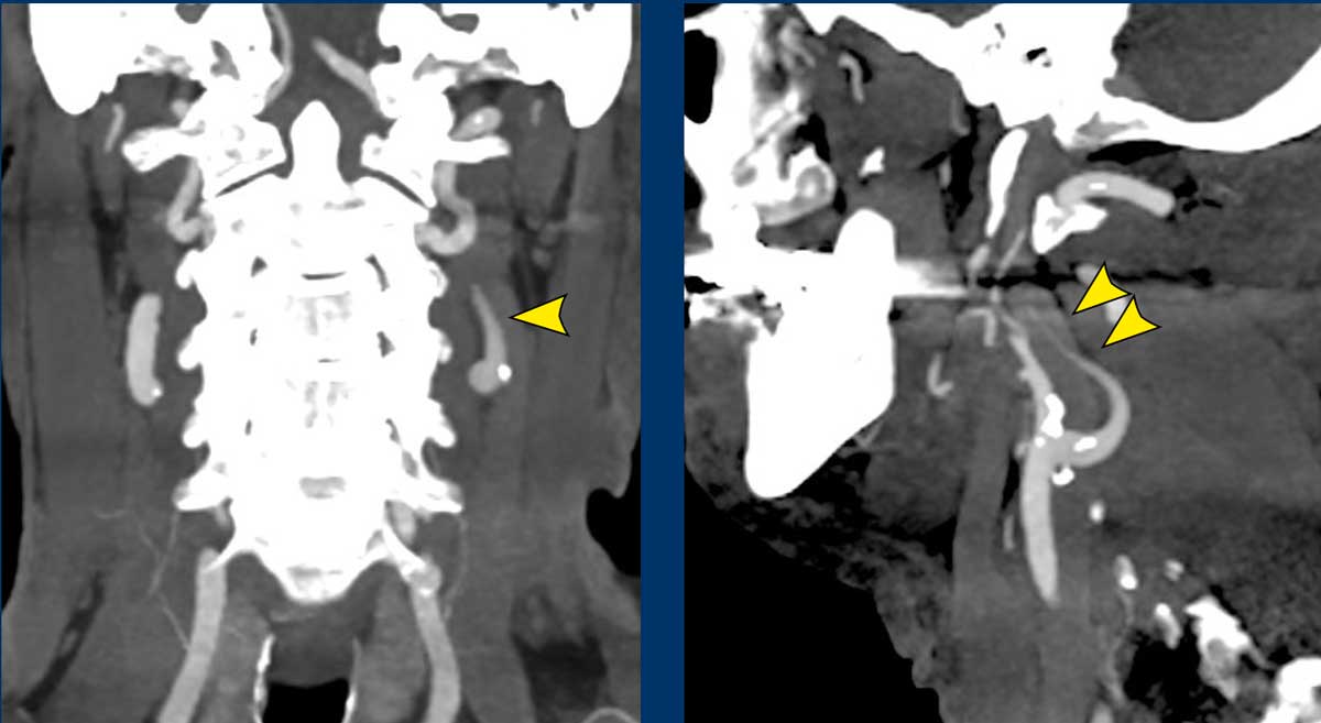 The Radiology Assistant : Horner syndrome.