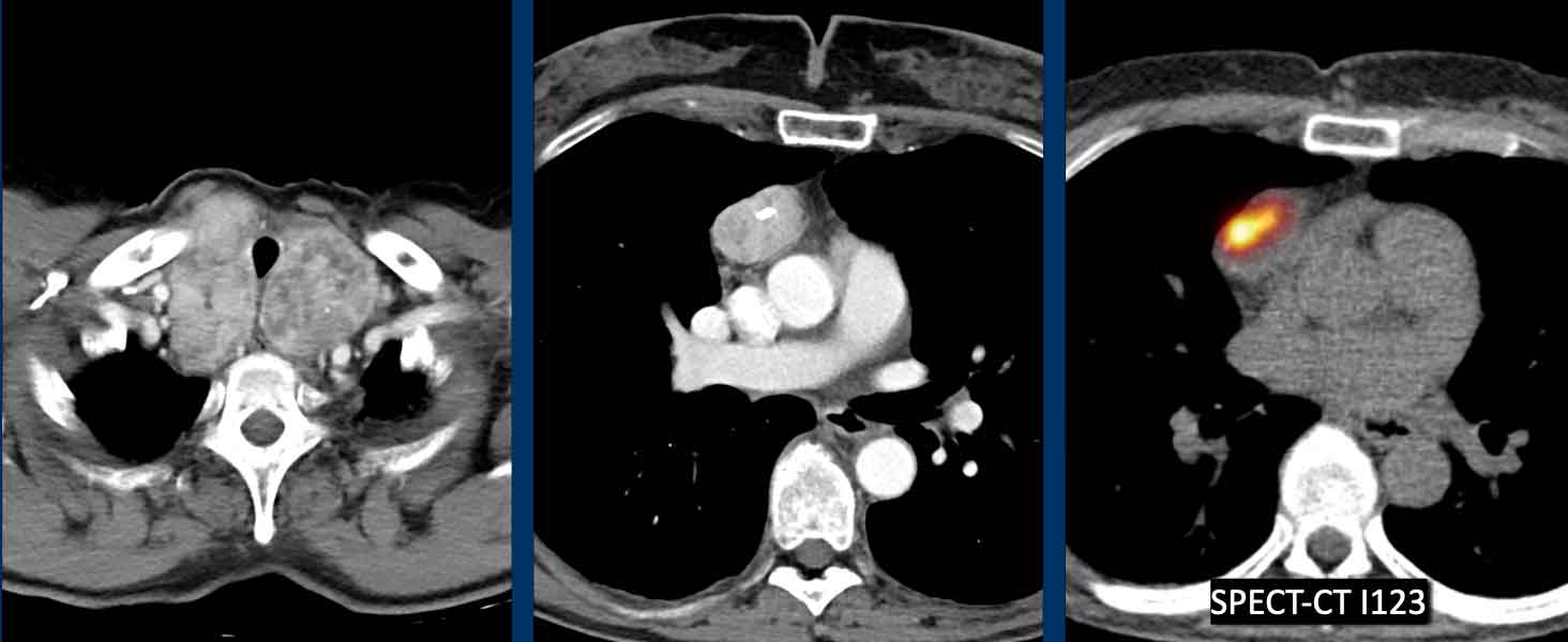 The Radiology Assistant : Thymic masses and mimics