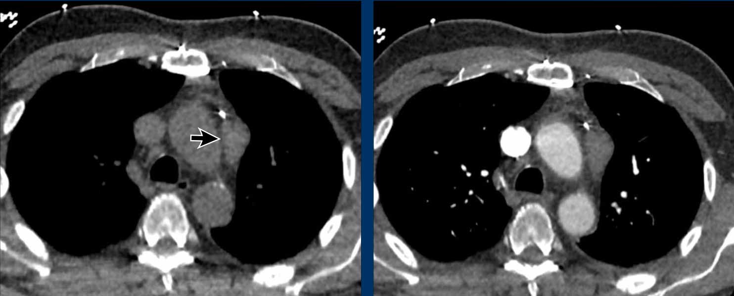 The Radiology Assistant : Thymic masses and mimics