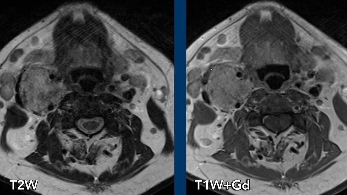 The Radiology Assistant : Horner syndrome