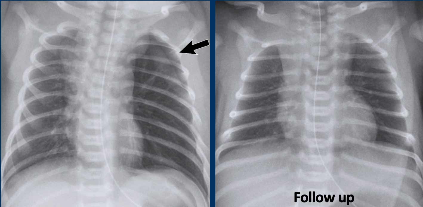 The Radiology Assistant : Neonatal Chest X-Ray