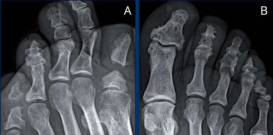 The Radiology Assistant : Arthritis
