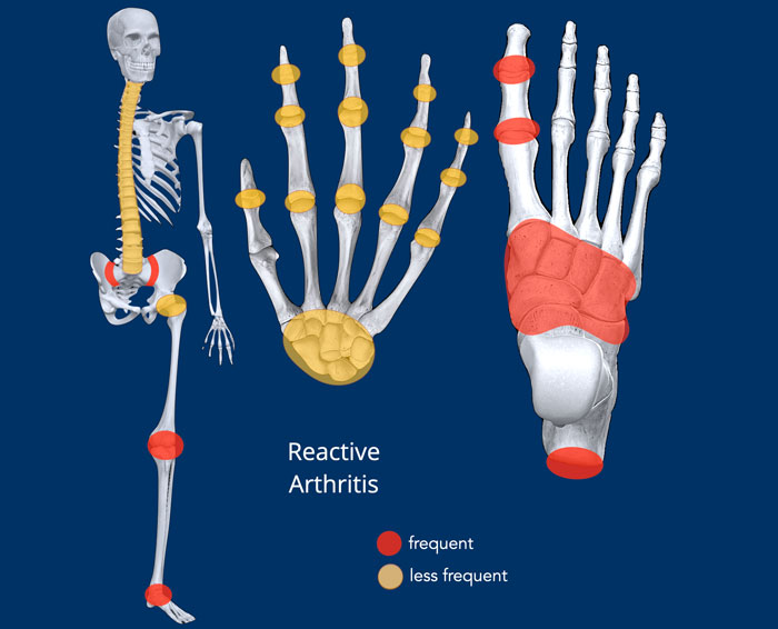 The Radiology Assistant : Arthritis
