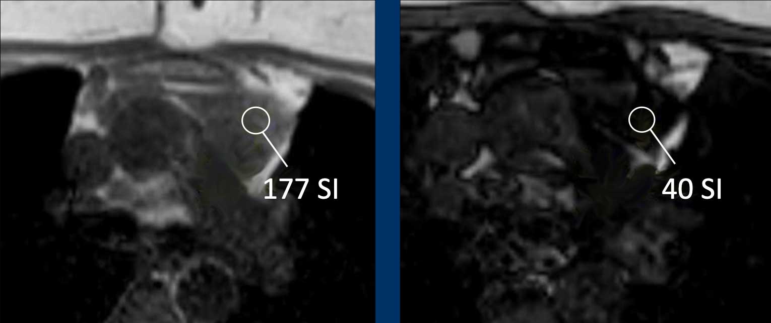 The Radiology Assistant : Thymic masses and mimics