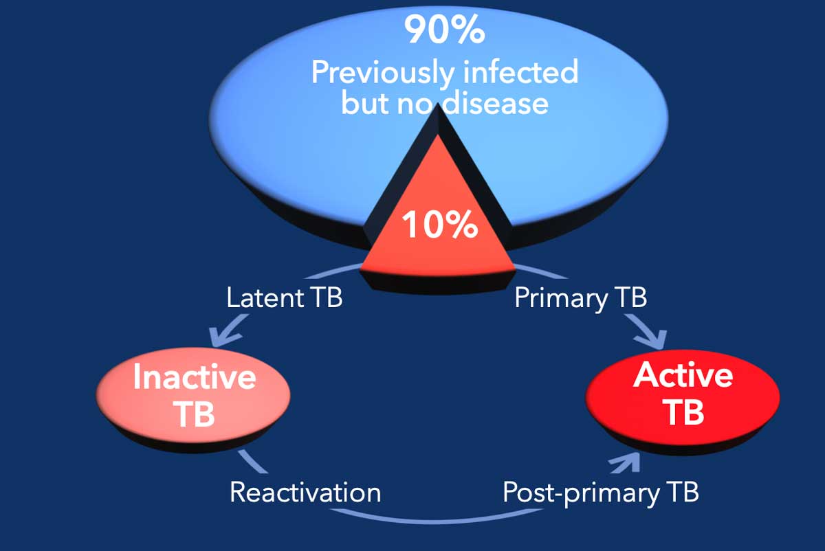 The Radiology Assistant : Imaging findings in TB
