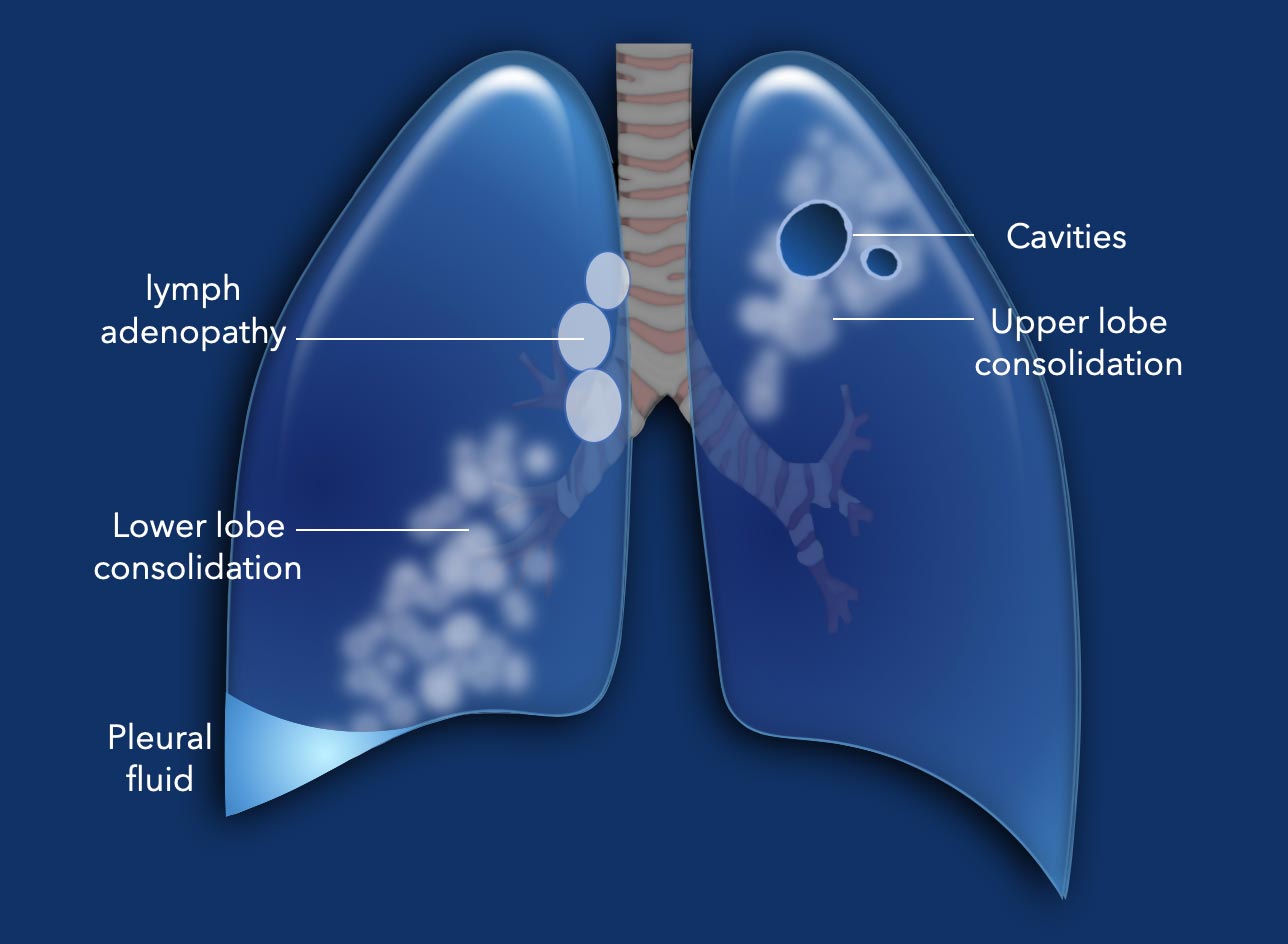 The Radiology Assistant : Imaging findings in TB