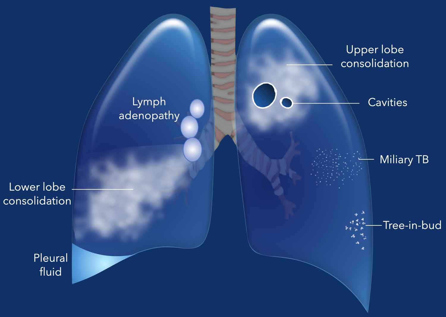 The Radiology Assistant : Imaging findings in TB