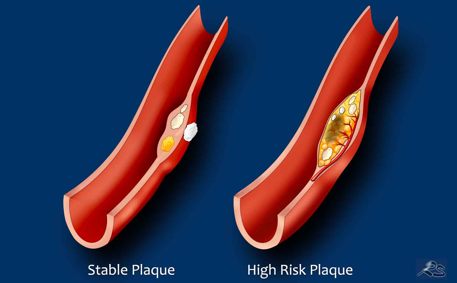 The Radiology Assistant : Coronary Artery Disease-Reporting and Data ...
