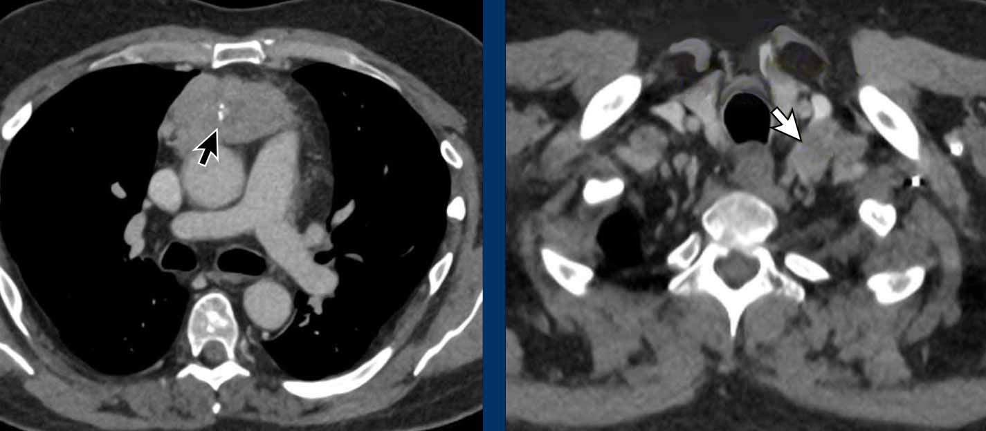 The Radiology Assistant : Thymic masses and mimics