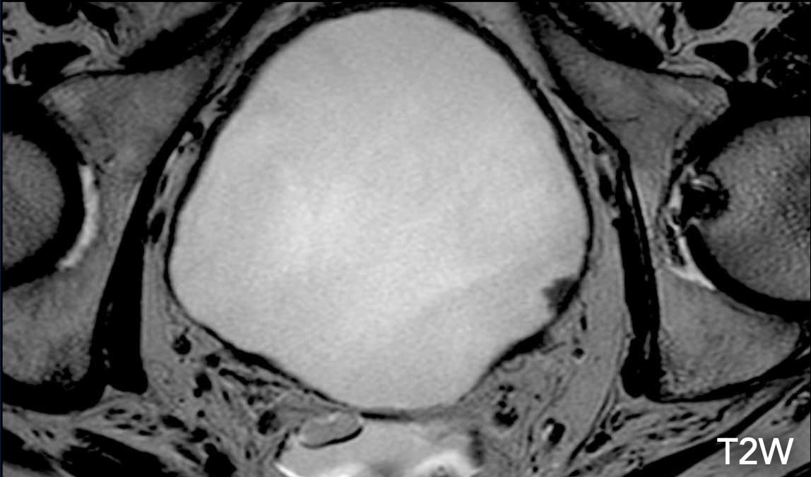 The Radiology Assistant : Bladder Cancer - VI-RADS