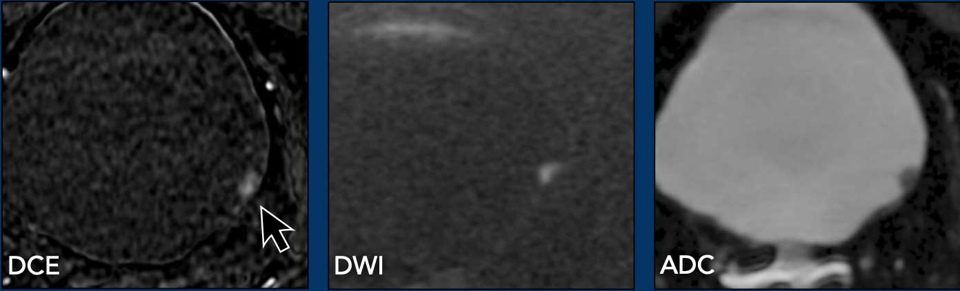 The Radiology Assistant : Bladder Cancer - VI-RADS