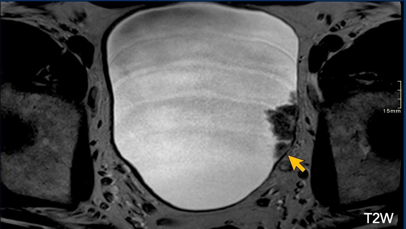 The Radiology Assistant : Bladder Cancer - VI-RADS