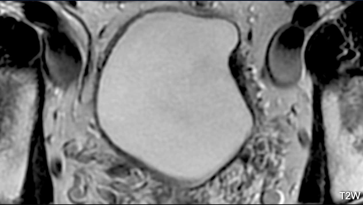 The Radiology Assistant : Bladder Cancer - VI-RADS