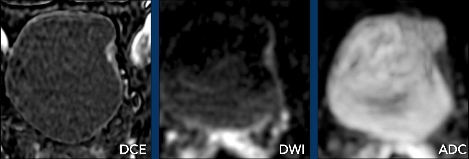 The Radiology Assistant : Bladder Cancer - VI-RADS