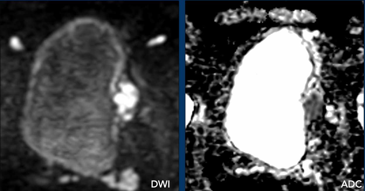 The Radiology Assistant : Bladder Cancer - VI-RADS