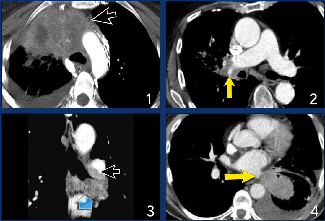 The Radiology Assistant : TNM classification 9ᵗʰ edition