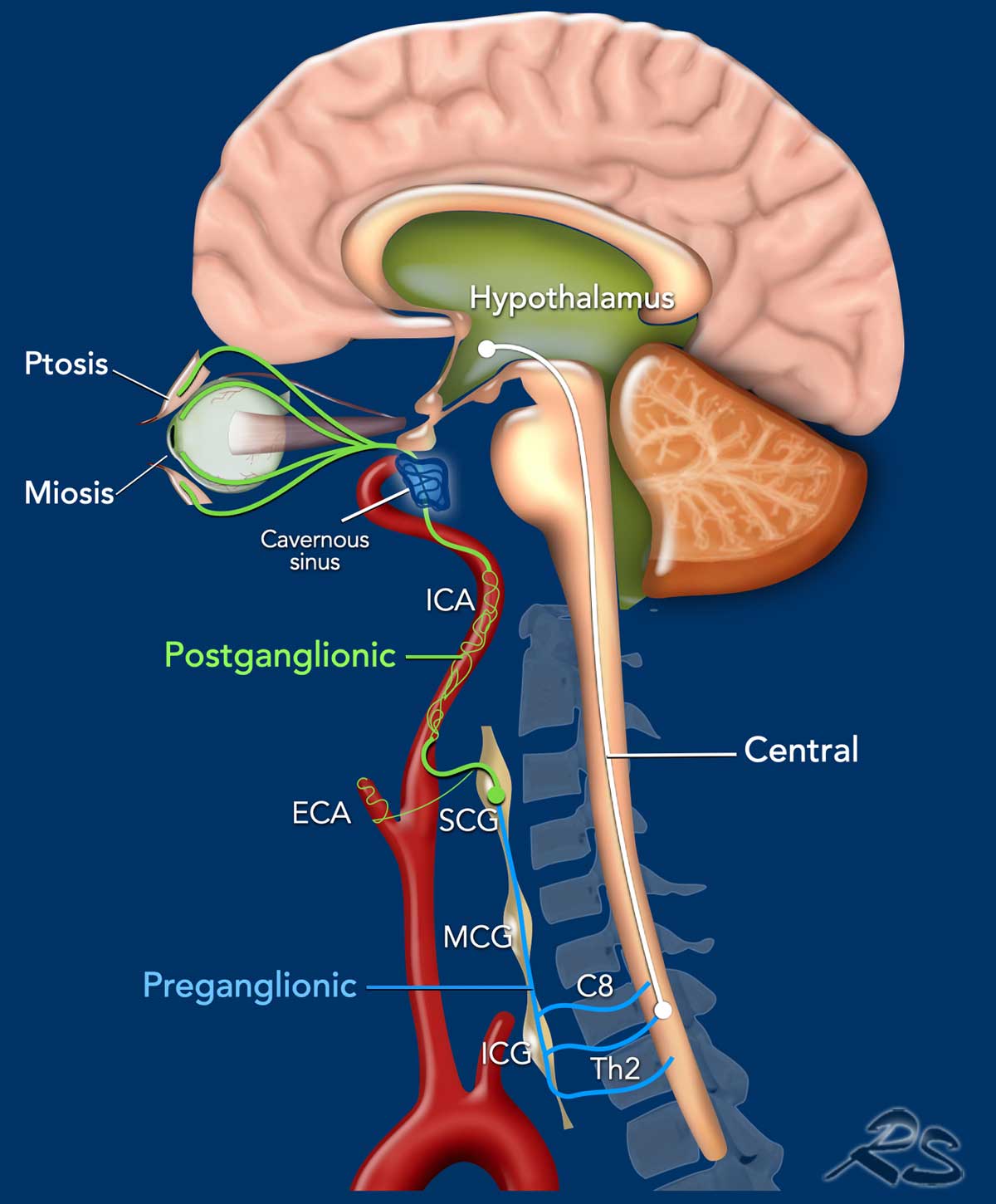 The Radiology Assistant : Horner syndrome.