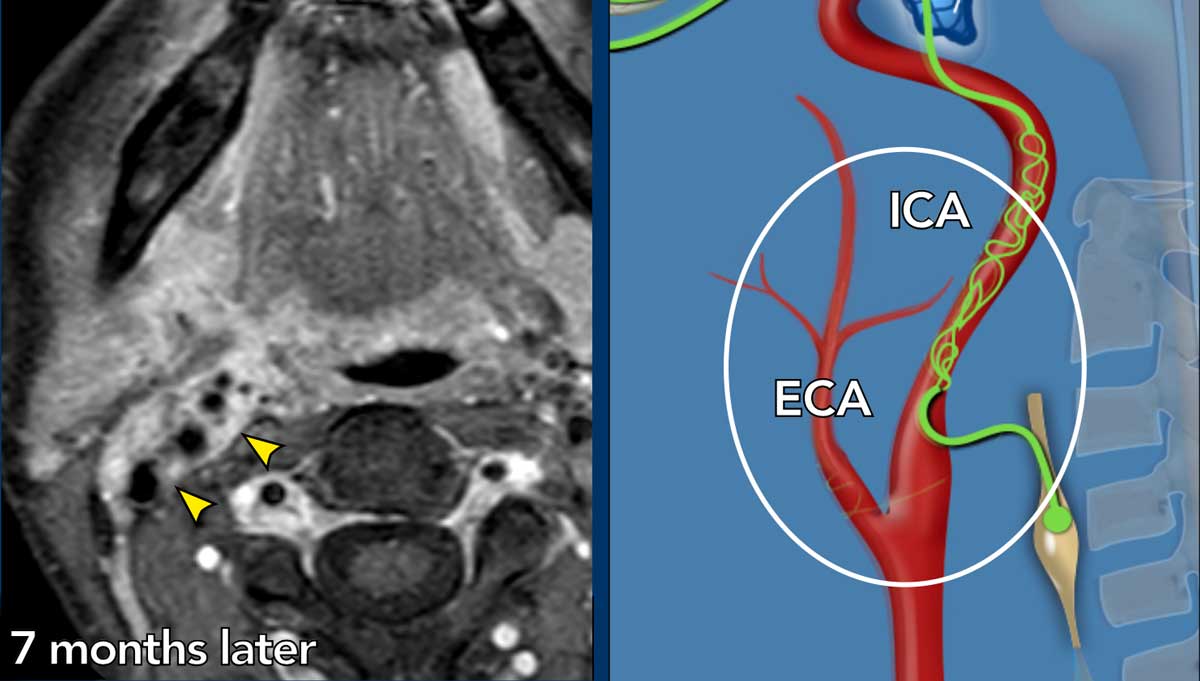 The Radiology Assistant : Horner syndrome.