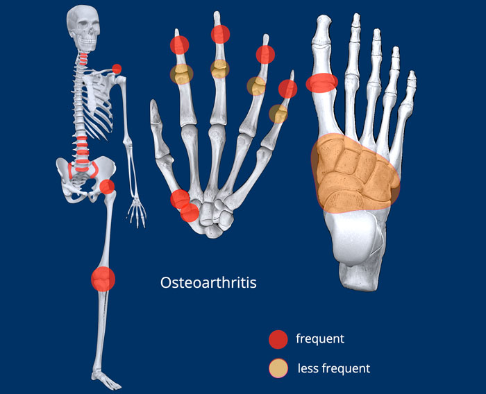The Radiology Assistant : Arthritis