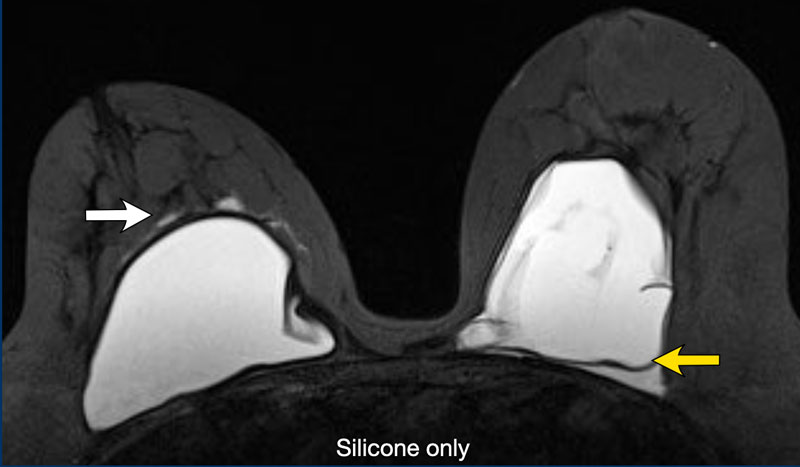The Radiology Assistant : Breast Implants