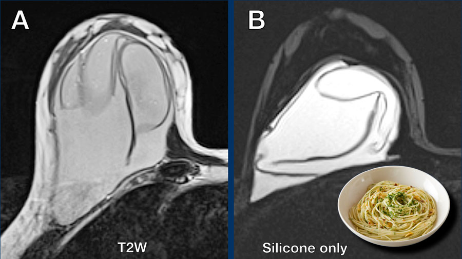 The Radiology Assistant : Breast Implants