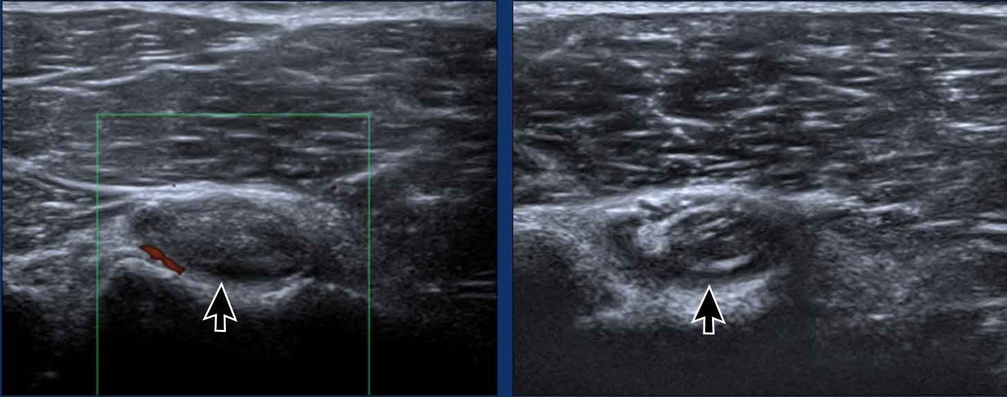 The Radiology Assistant : Shoulder Ultrasound