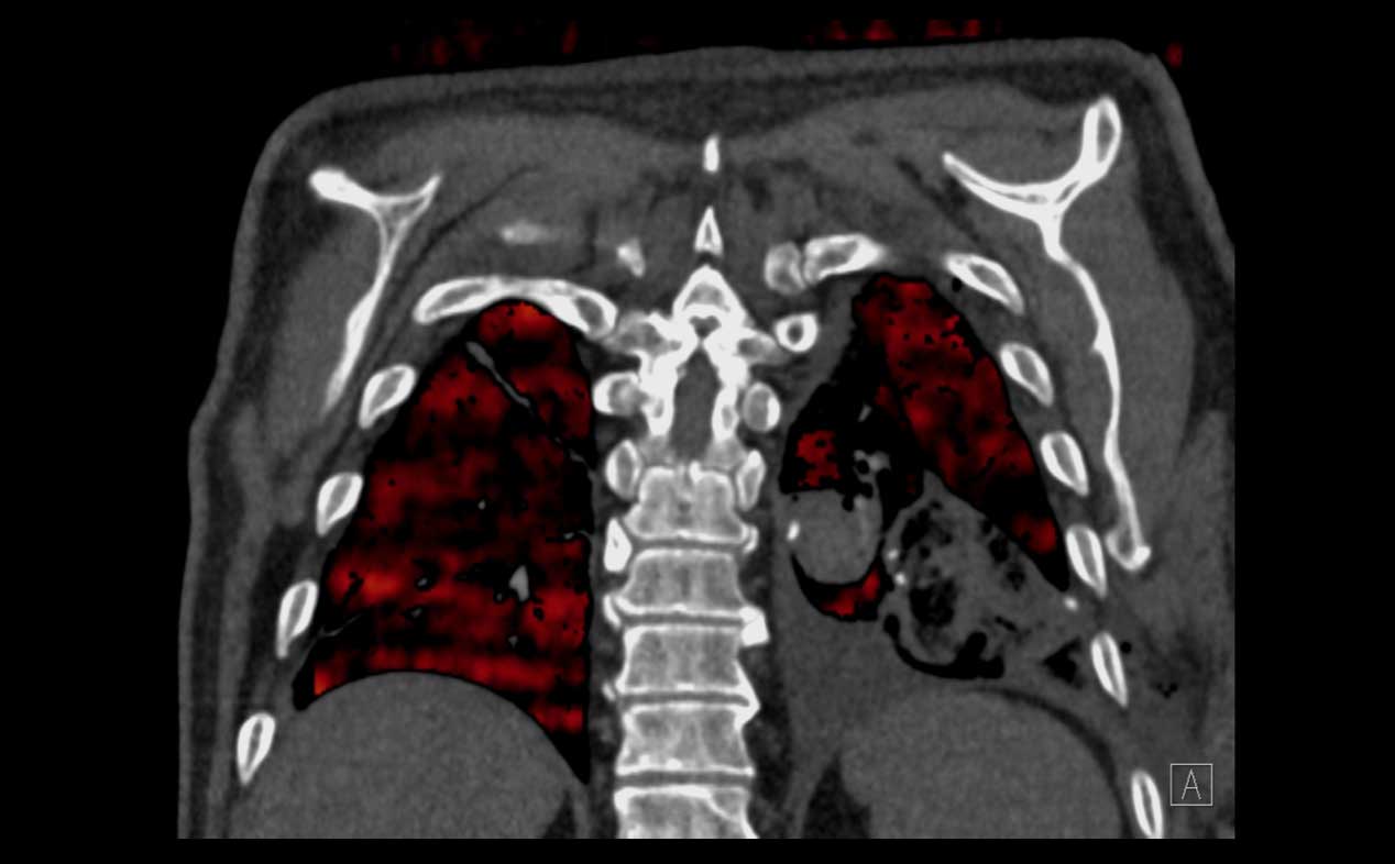 The Radiology Assistant : Lung Segments and Bronchi