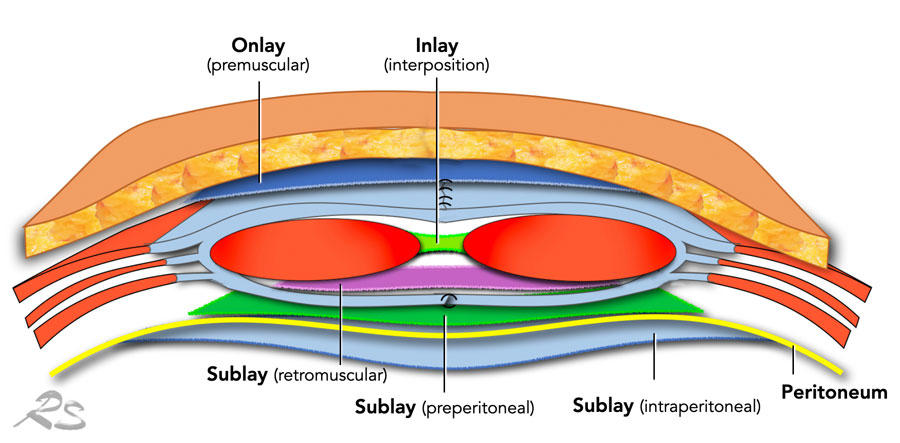 The Radiology Assistant : Abdominal wall hernias