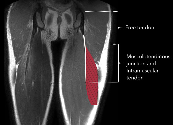 The Radiology Assistant : Hamstring injury