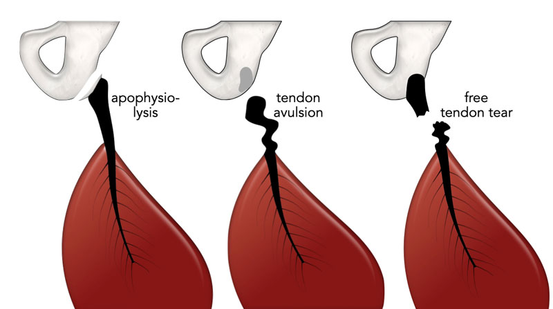The Radiology Assistant : Hamstring injury