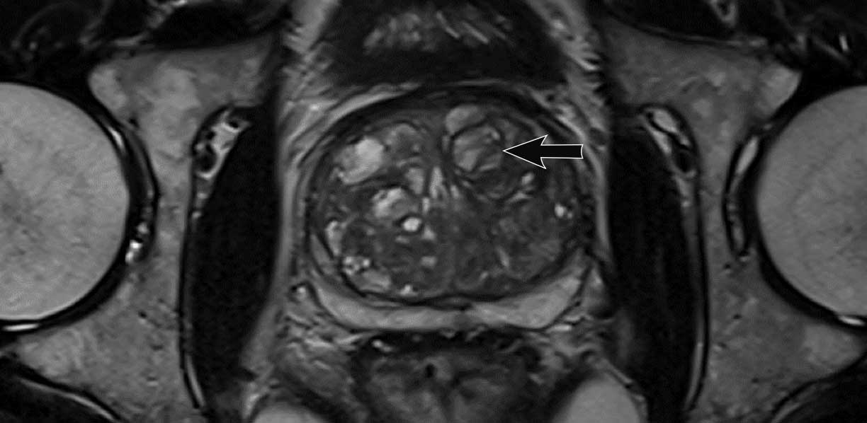 The Radiology Assistant : Prostate Cancer - PI-RADS v2.1
