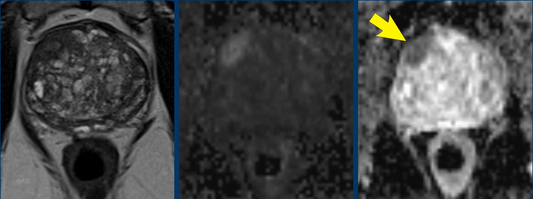 The Radiology Assistant : Prostate Cancer - PI-RADS v2.1