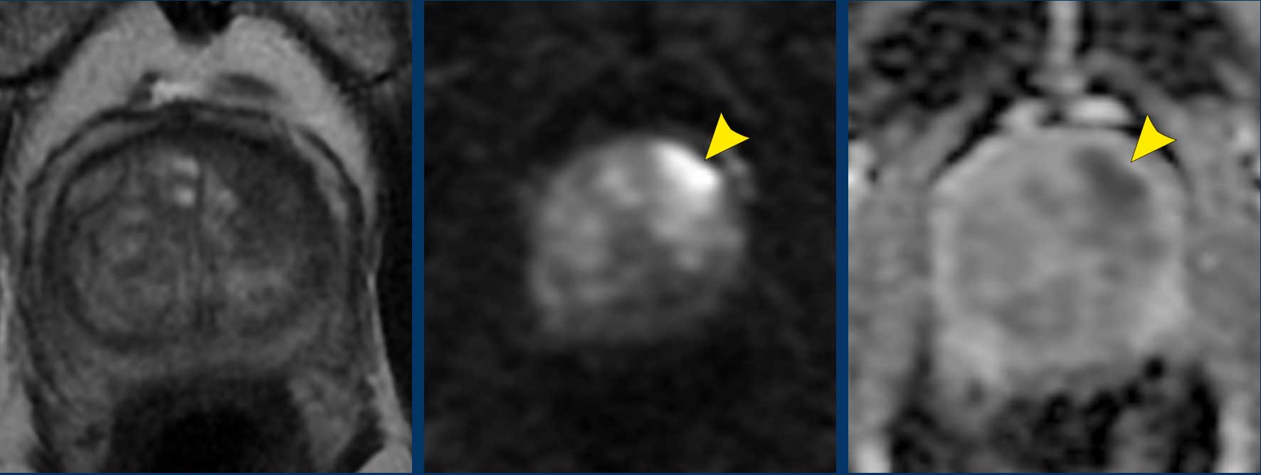 The Radiology Assistant : Prostate Cancer - PI-RADS v2.1
