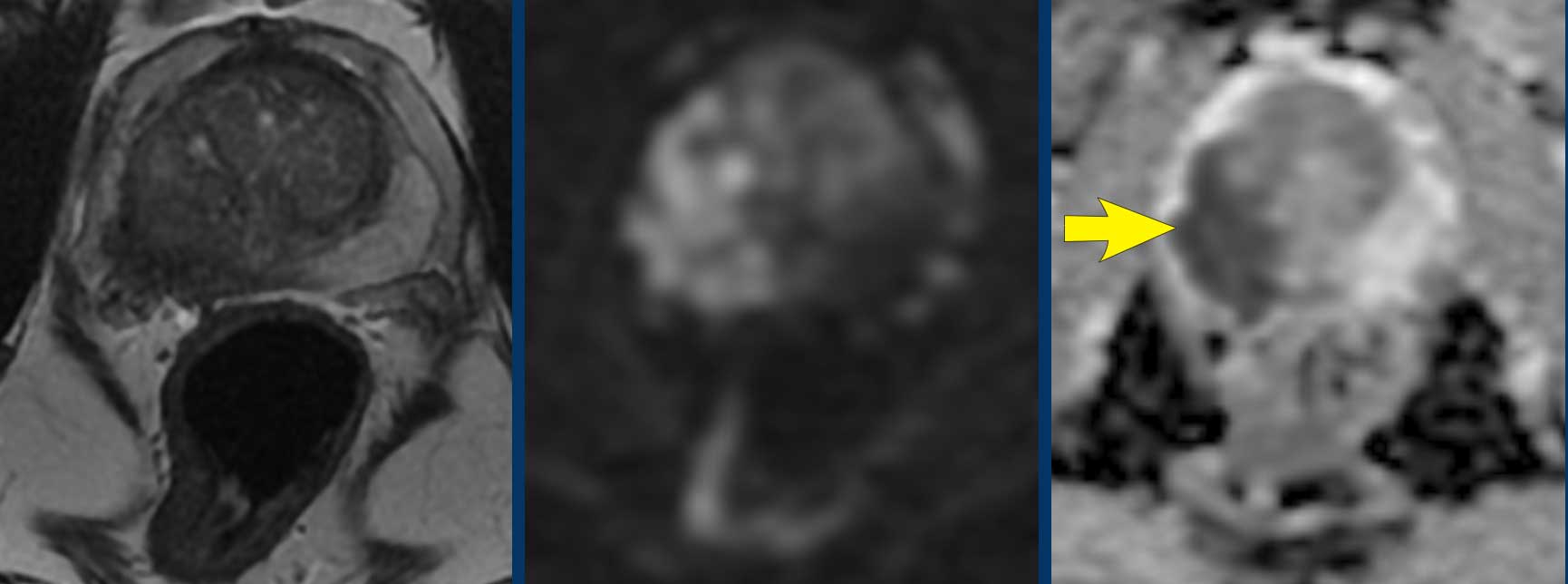 The Radiology Assistant : Prostate Cancer - PI-RADS v2.1