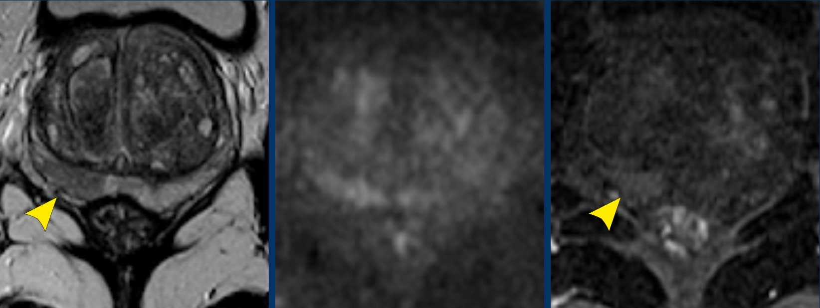 The Radiology Assistant : Prostate Cancer - PI-RADS v2.1