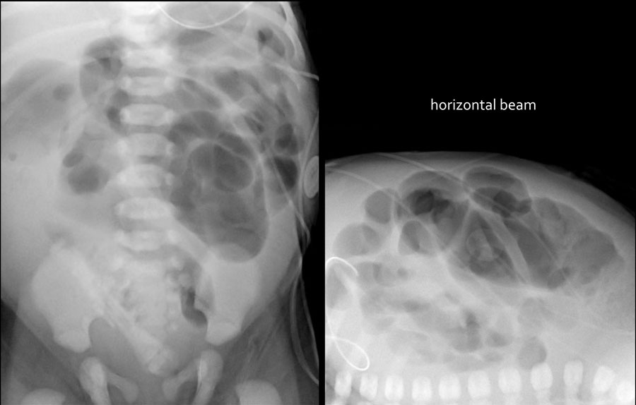 The Radiology Assistant : Acute Abdomen in Neonates