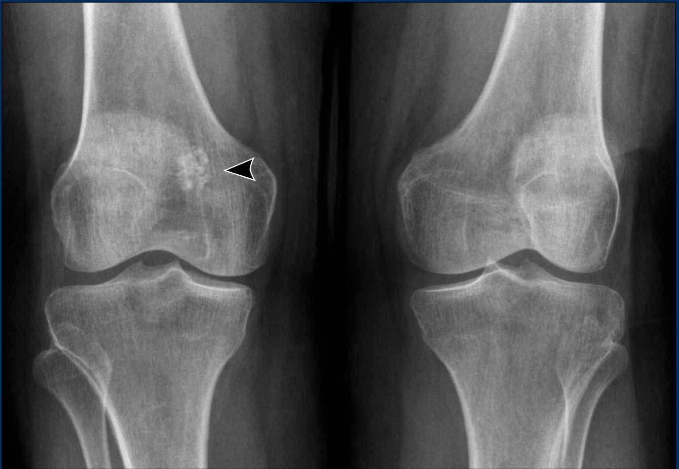 The Radiology Assistant : Cartilage tumors