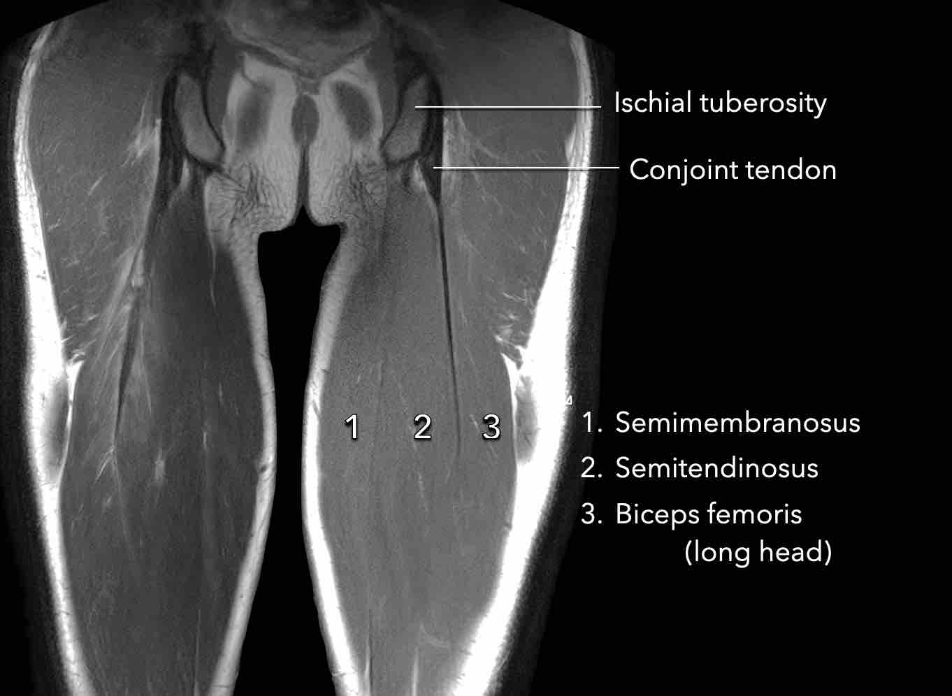 The Radiology Assistant : Hamstring injury