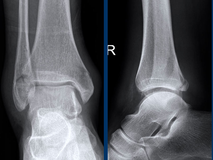 The Radiology Assistant : Foot and Ankle cases