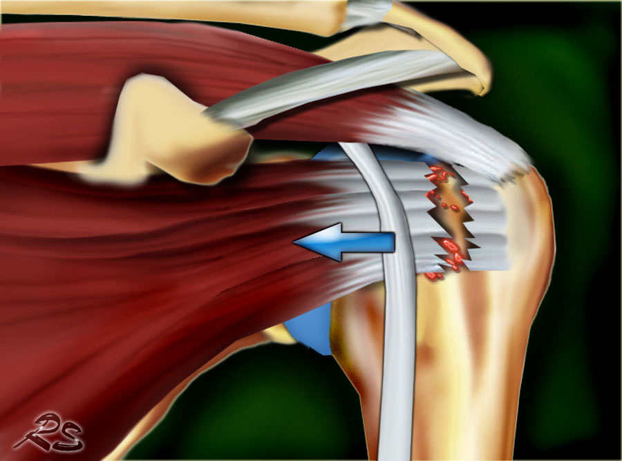 The Radiology Assistant : Shoulder - Rotator cuff injury