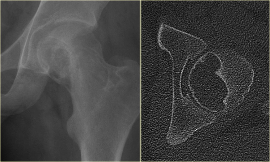 The Radiology Assistant : Bone tumor A-G