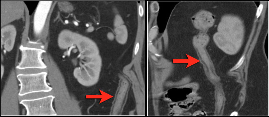 The Radiology Assistant : CT-pattern of Bowel wall thickening