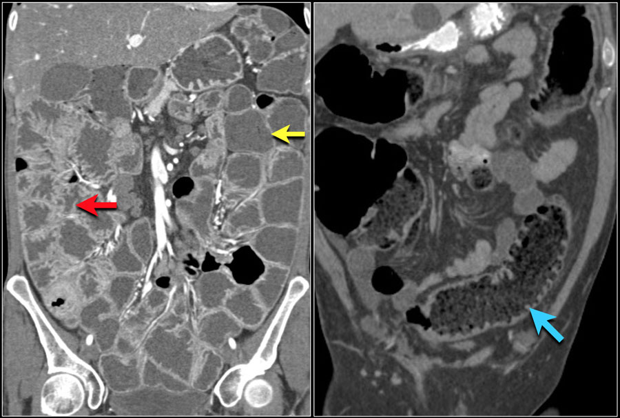 The Radiology Assistant : CT-pattern of Bowel wall thickening