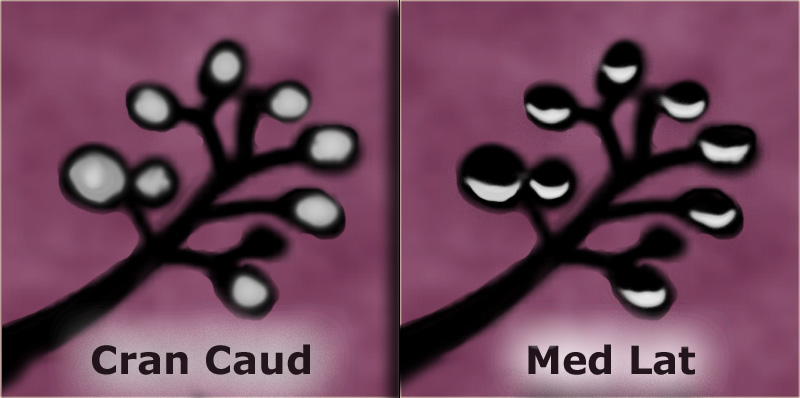 The Radiology Assistant : Differential of Breast Calcifications