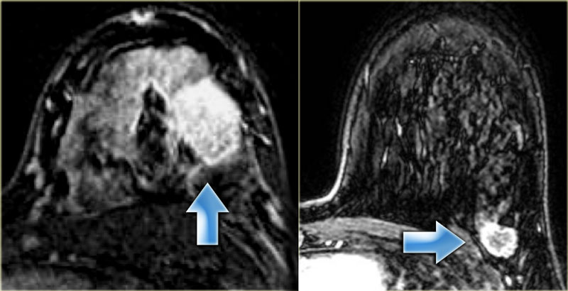 The Radiology Assistant : MRI of the Breast